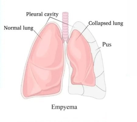 Empyema Treatment by Expert London Thoracic Surgeon | Comprehensive Care